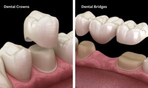 How Dental Crowns & Bridges Can Fix Missing or Damaged Teeth
